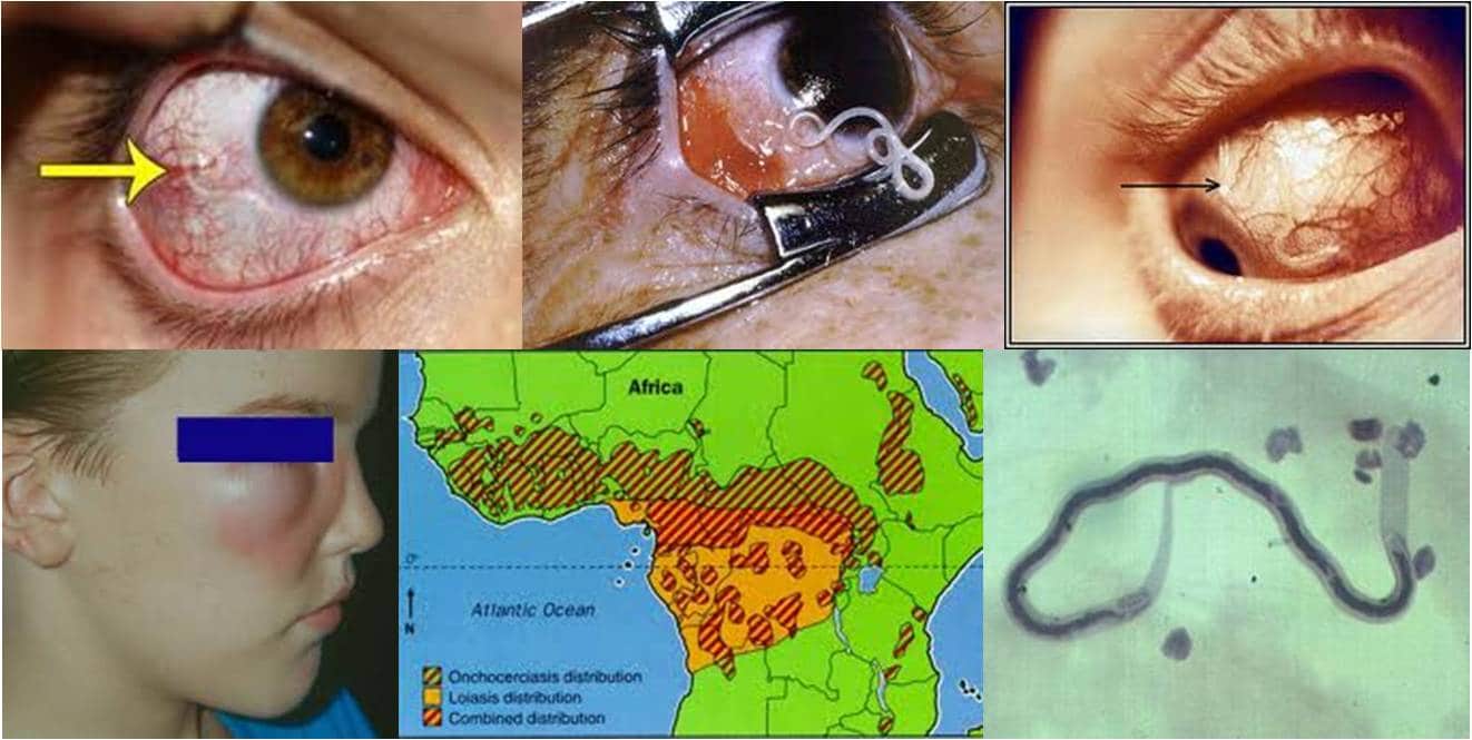 The 10 Most Horrifying Parasites that Infect Humans - Net Worth Post